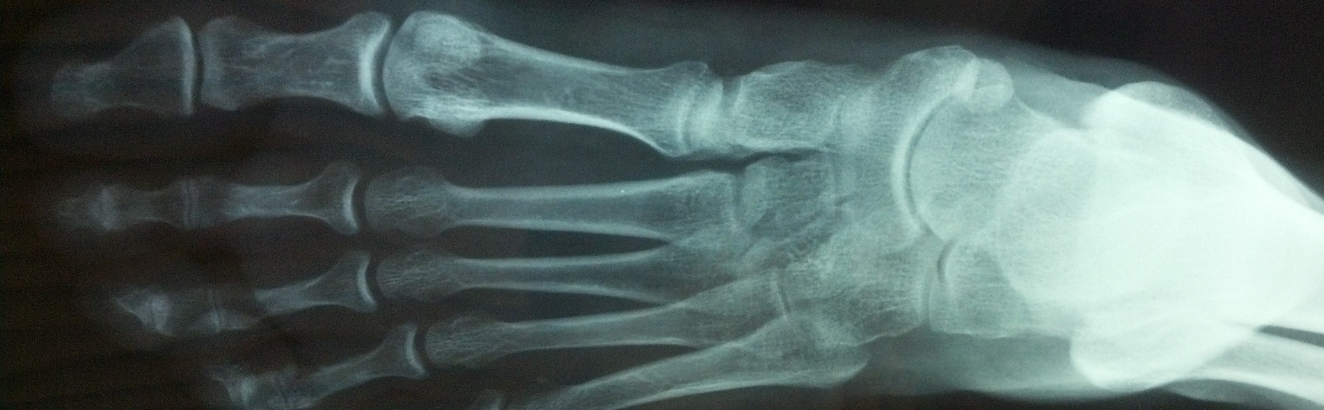 x-ray-foot | Bentley Podiatry